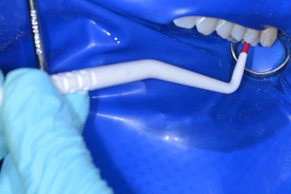 Why Do Clinicians Mistrust Bulk Fills for Class II’s? - Bioclear