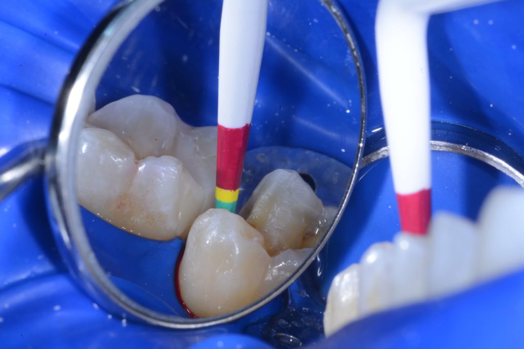 Why Do Clinicians Mistrust Bulk Fills for Class II’s? - Bioclear