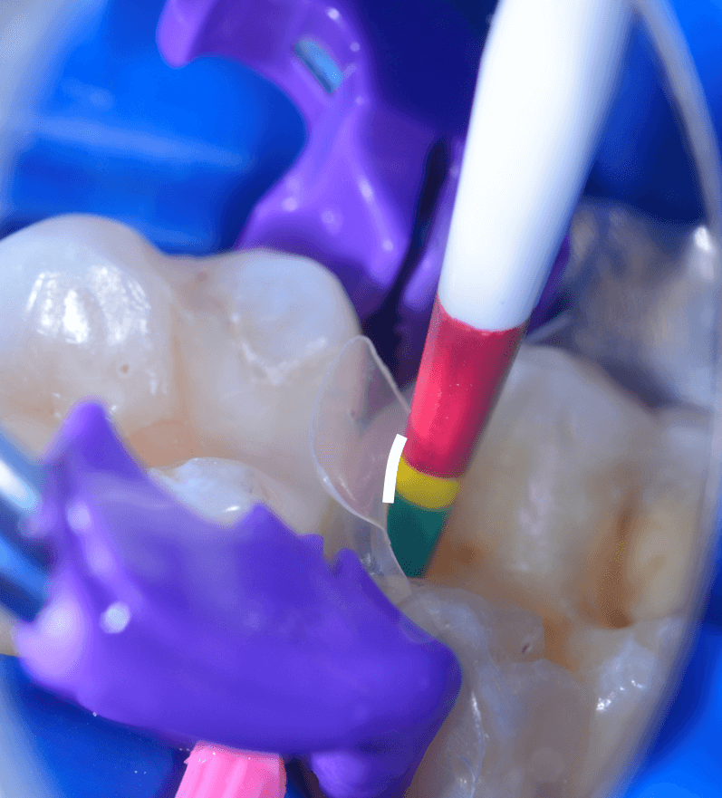 Why Do Clinicians Mistrust Bulk Fills for Class II’s? - Bioclear