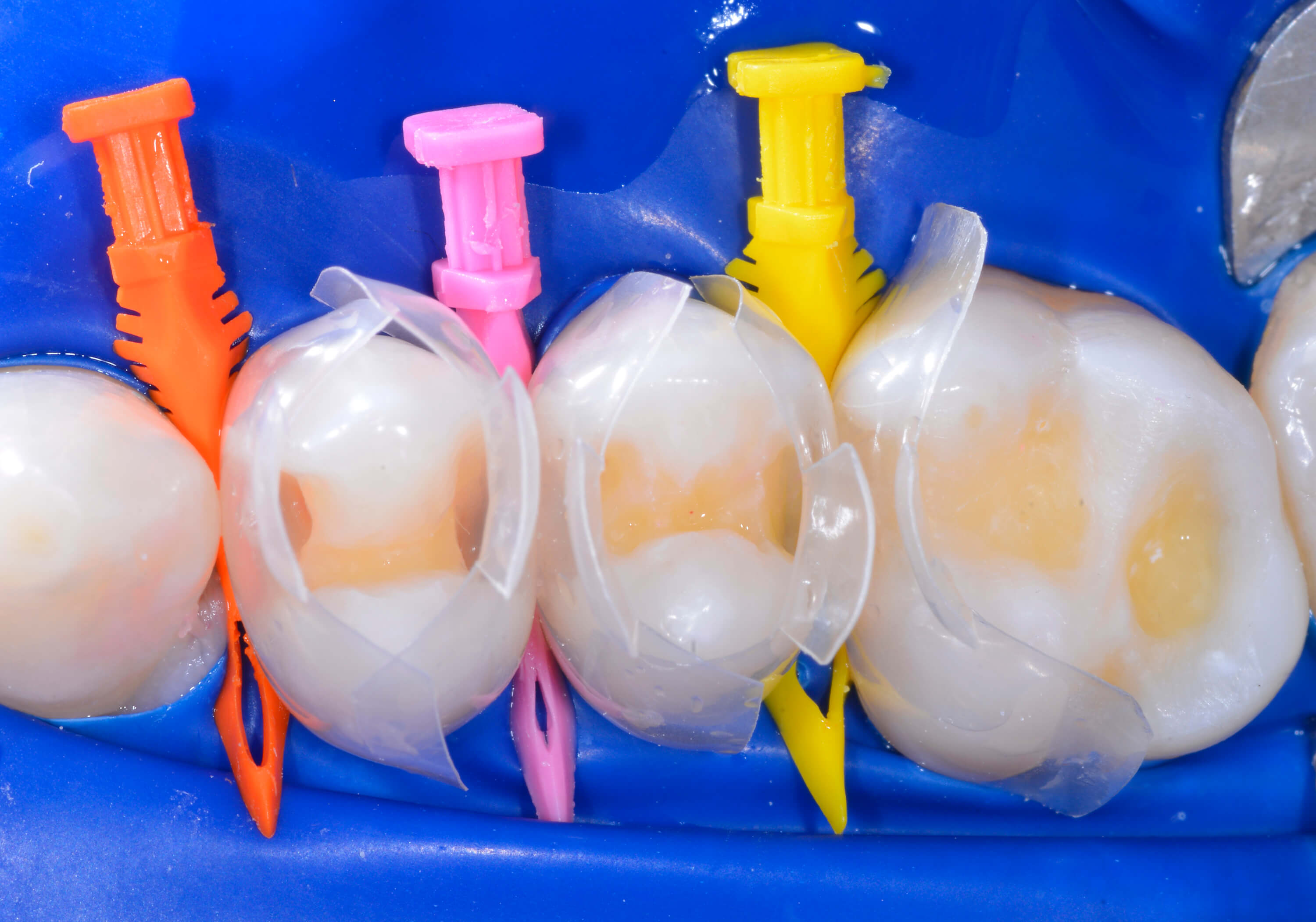 Biofit Part 3 - Injection Molding a Modern Class II - Bioclear