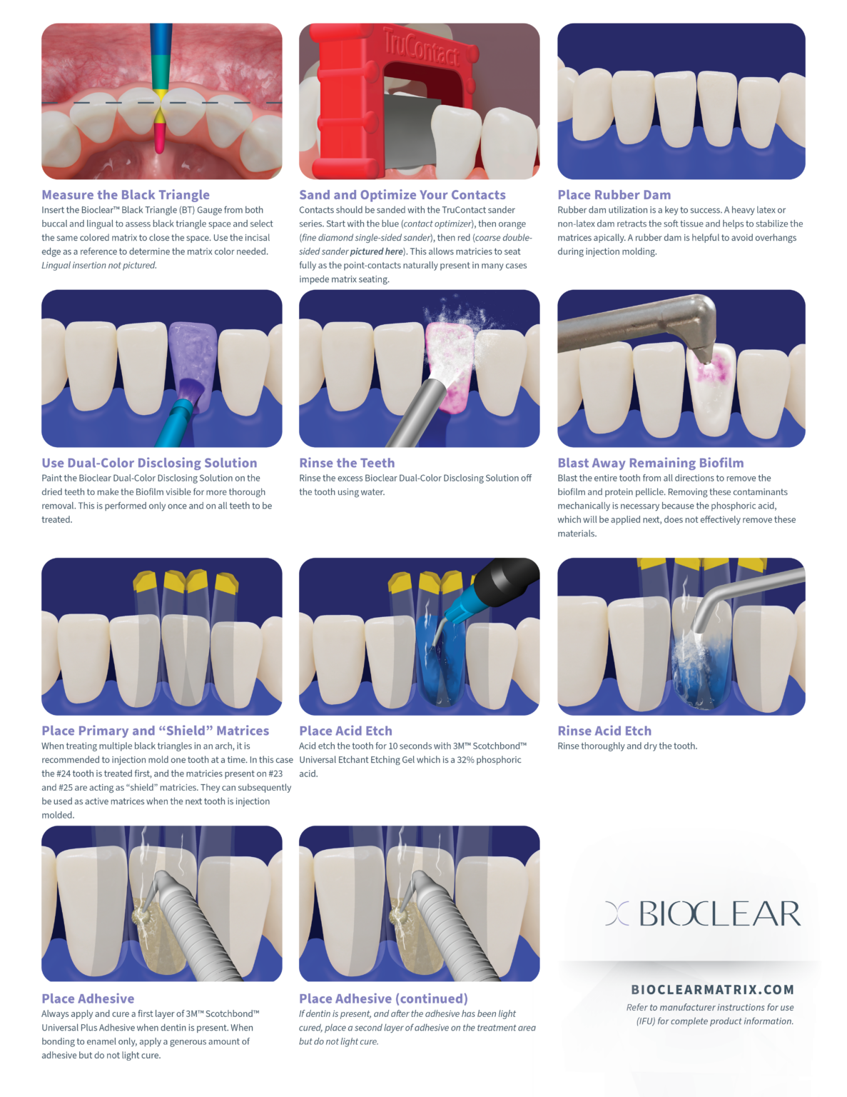 Illustrated Black Triangle Procedural Guide - Bioclear
