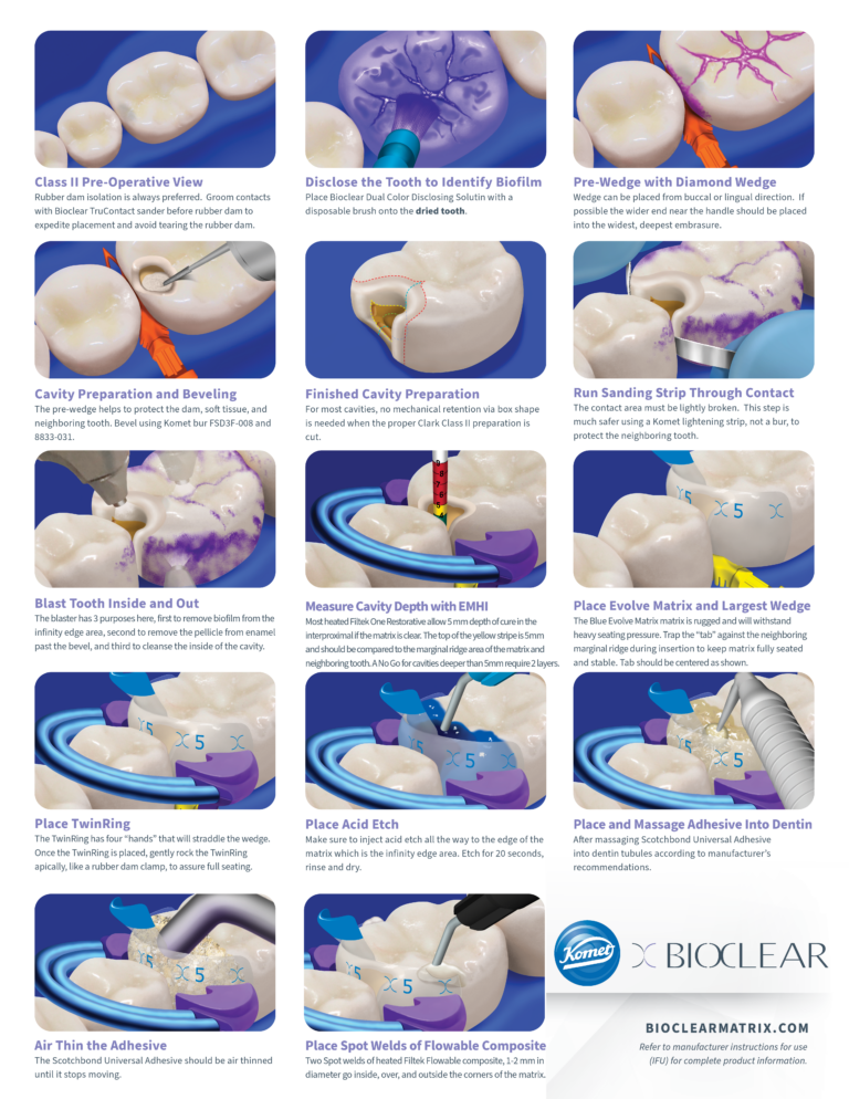 Bioclear Class II - Bioclear